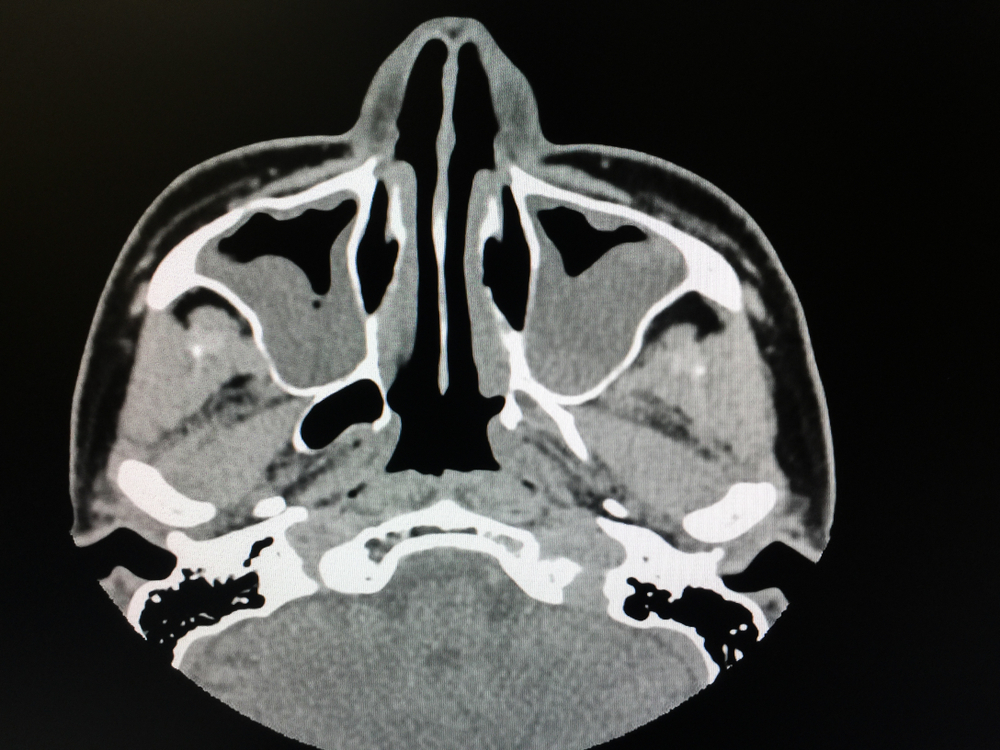 Nasal Polyps Symptoms Causes Risk And Prevention